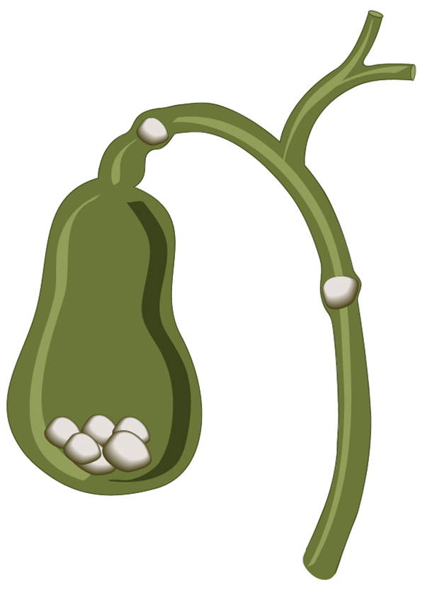 Galstenen: oorzaken, risico's en functie van de galblaas