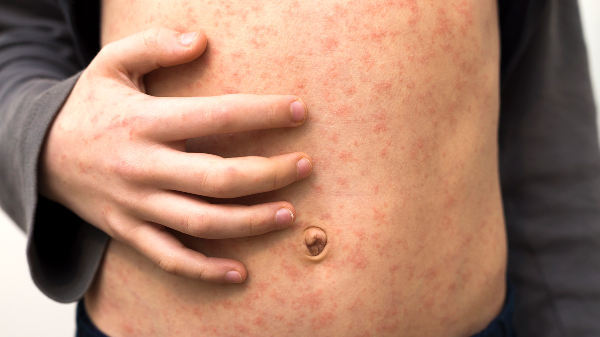 Oorzaak, symptomen en risico van mazelen