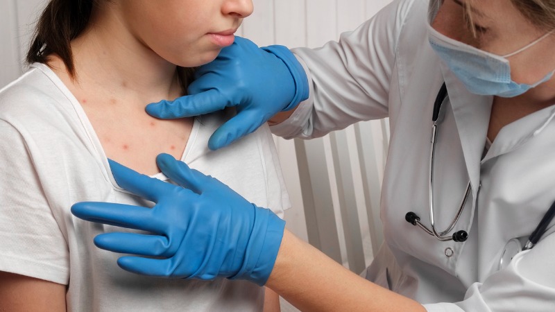 Apenpokken: symptomen, gevaren en behandelingen