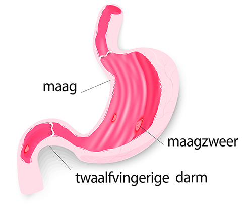 Maagzweer